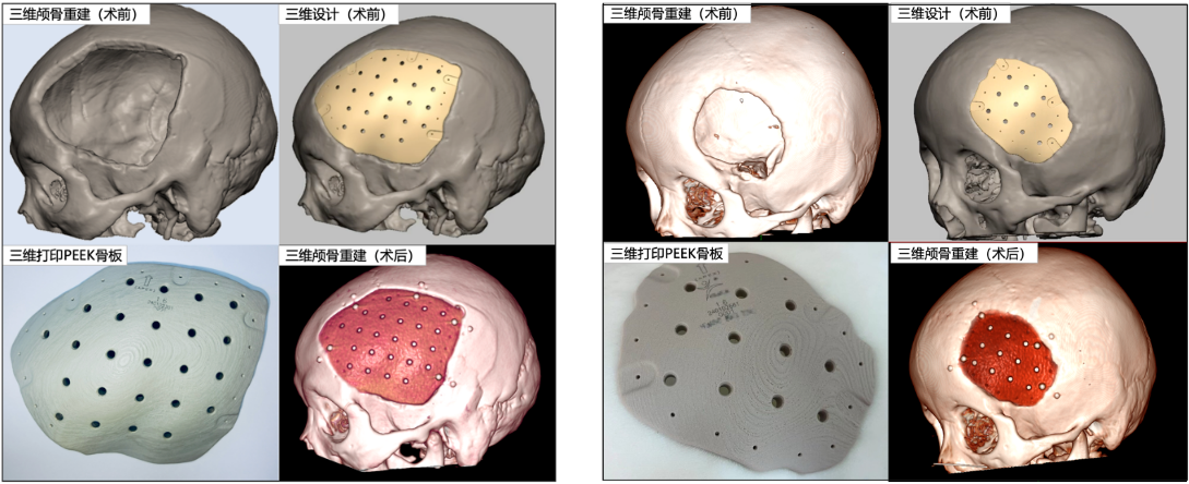 全球首次！PEEK应用新突破！这些企业加码布局生物医用PEEK！-大厂动态|Chatplas|塑料在线