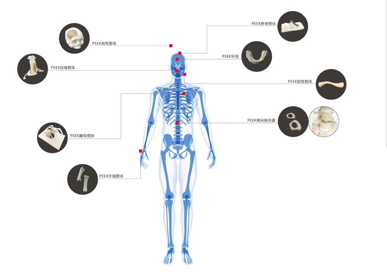 PEEK材料在医疗器械行业中的应用-行业前沿|Chatplas|塑料在线