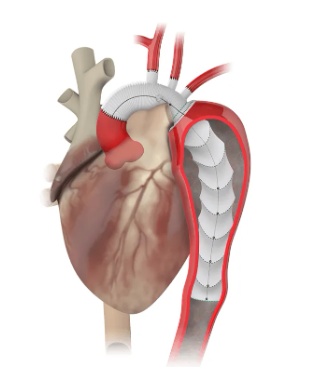 人工血管行业解读：从材料到临床应用及市场前景-大厂动态|Chatplas|塑料在线