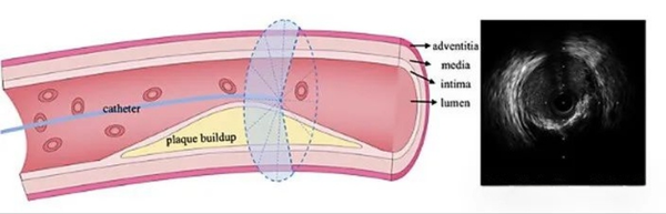 血管内超声（IVUS）设计原理、装配结构、和成像常见问题分析-材料干货|专塑视界|塑料在线