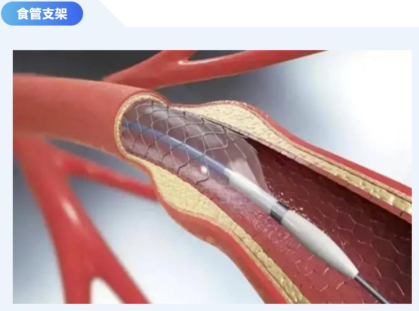 生物可降解医用材料！-行业前沿|Chatplas|塑料在线